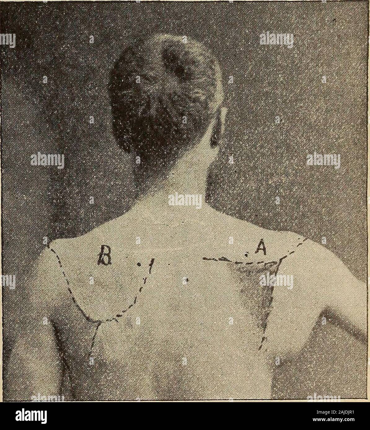 Inferior angle of the scapula hi-res stock photography and images - Alamy