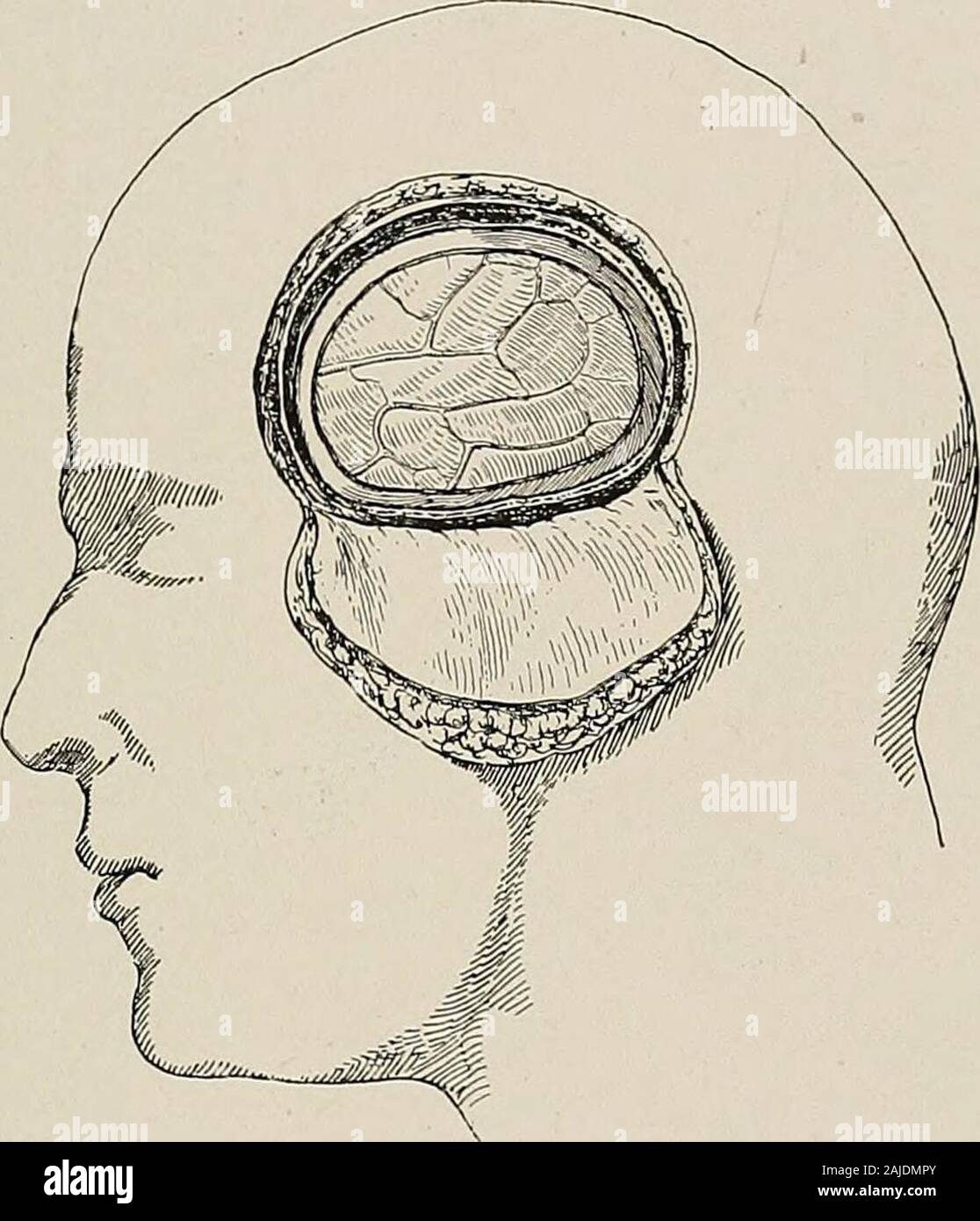 Hydrocephalus operation hi-res stock photography and images - Alamy