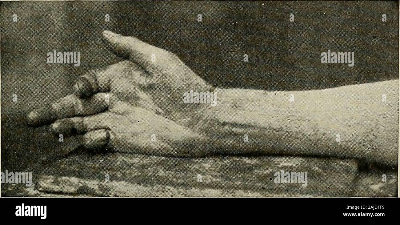 Cellulitis arm hi-res stock photography and images - Alamy