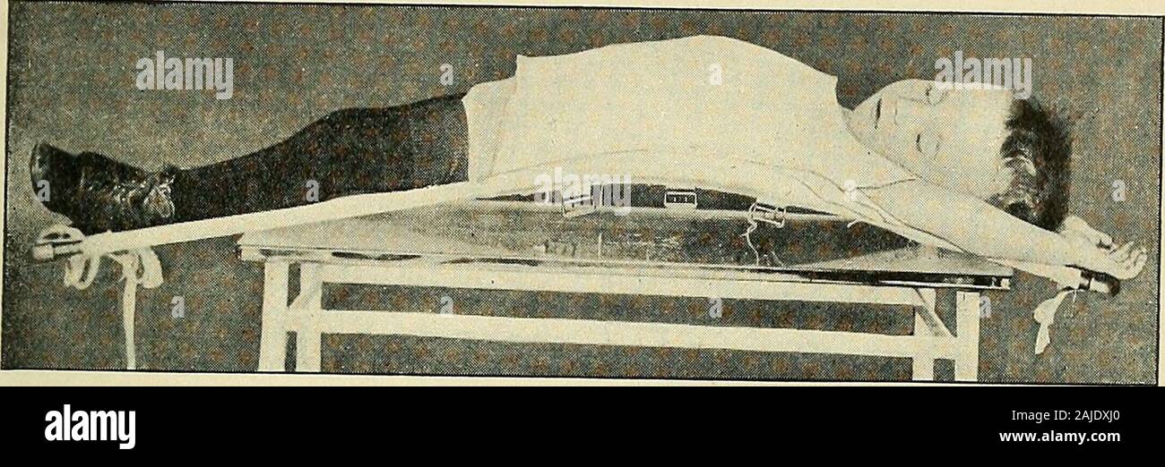 A treatise on orthopedic surgery . The plaster jacket applied in supine ...