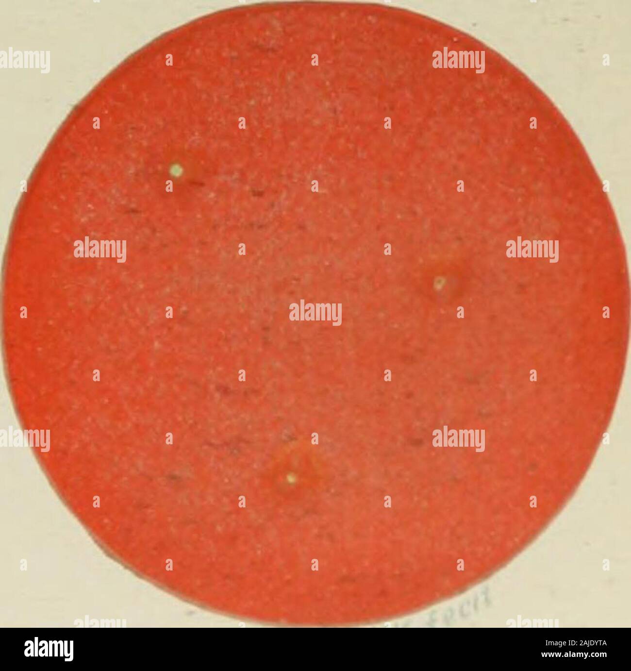 Koplik spots hi-res stock photography and images - Alamy