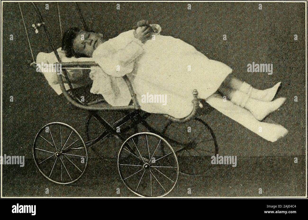 A treatise on orthopedic surgery . An x-my picture of the case (Fig. 34 ...