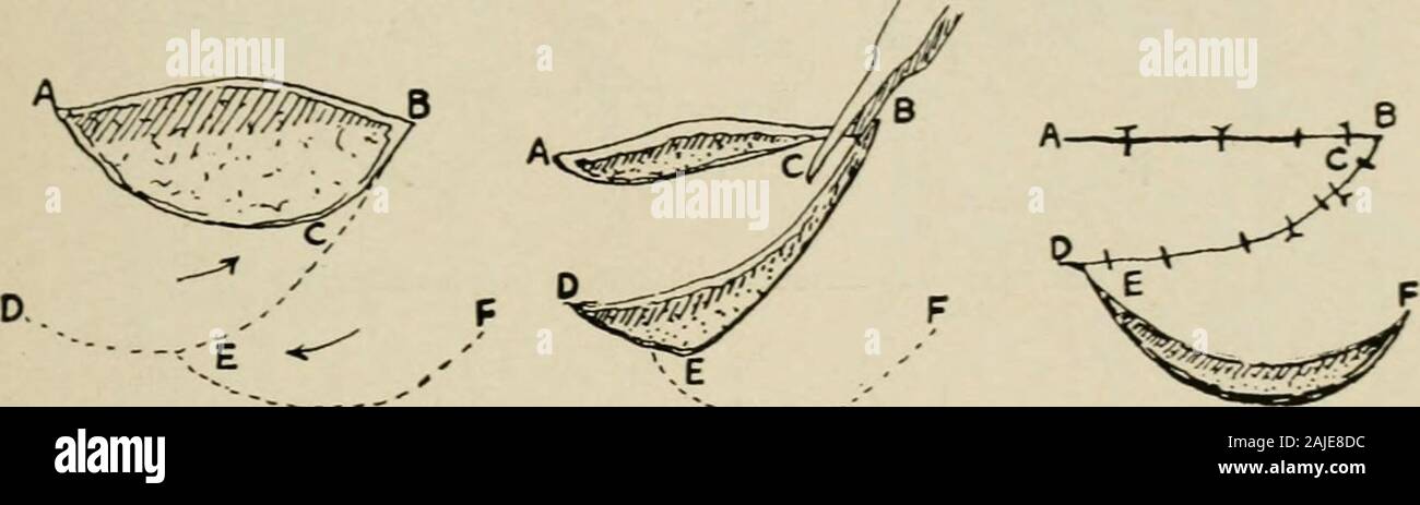 Plastic surgery; its principles and practice . Fig. 35.—Double ...