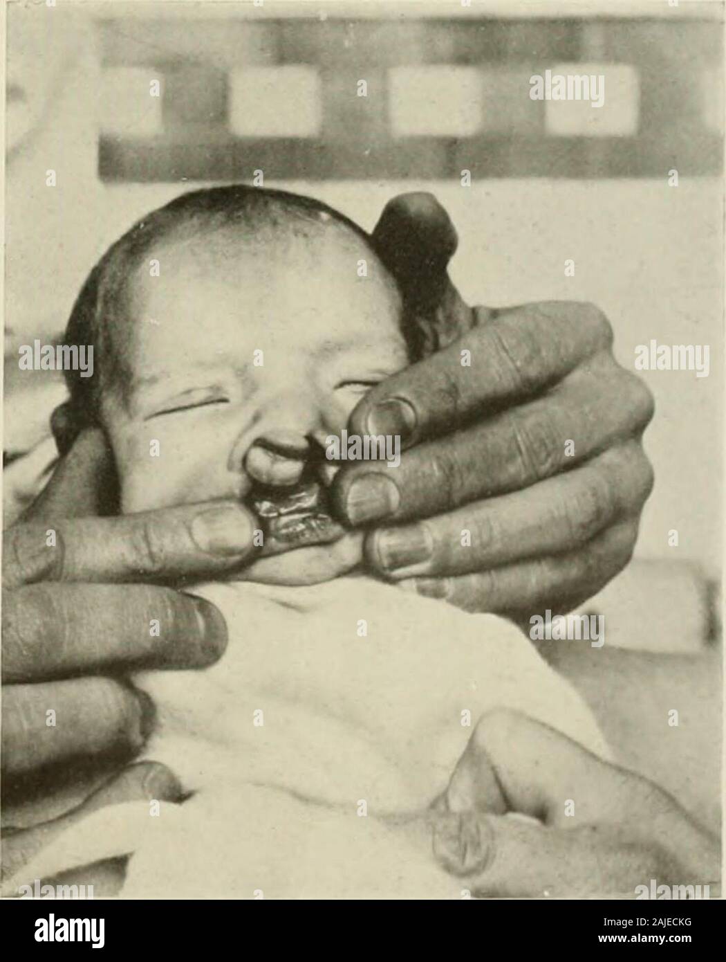 Treasury of human inheritance . Fig. 20. Bilateral hare lip, cleft of ...