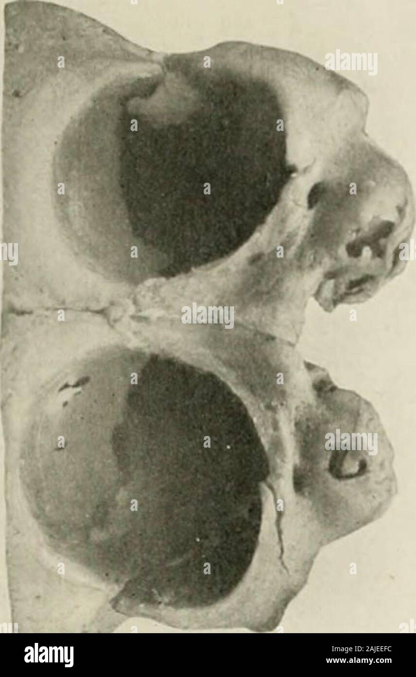 Treasury of human inheritance . Fig. 6. Left haie-lip, cleft iialate ...