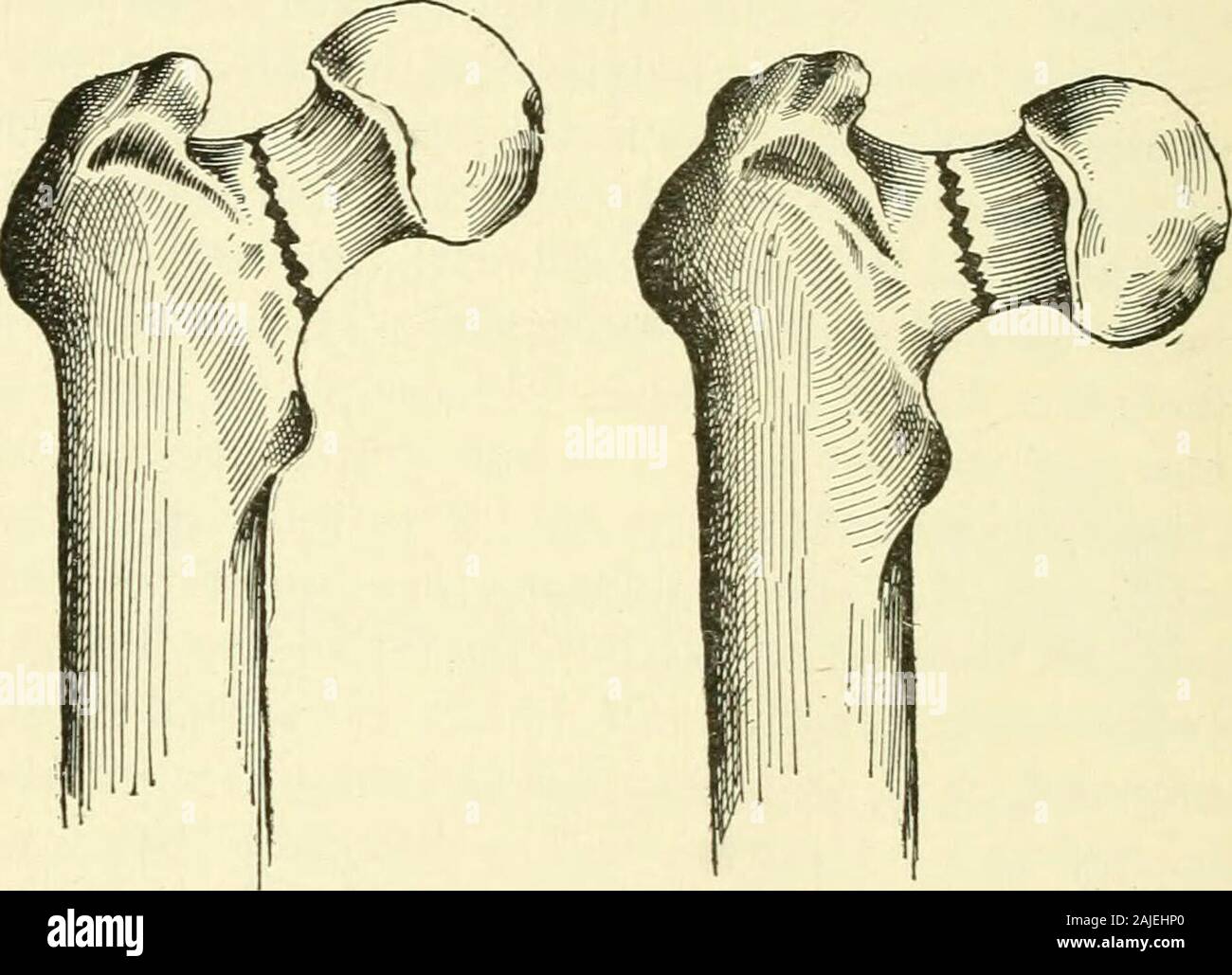 The treatment of fractures . horizontalization of the neck occurs.The ...