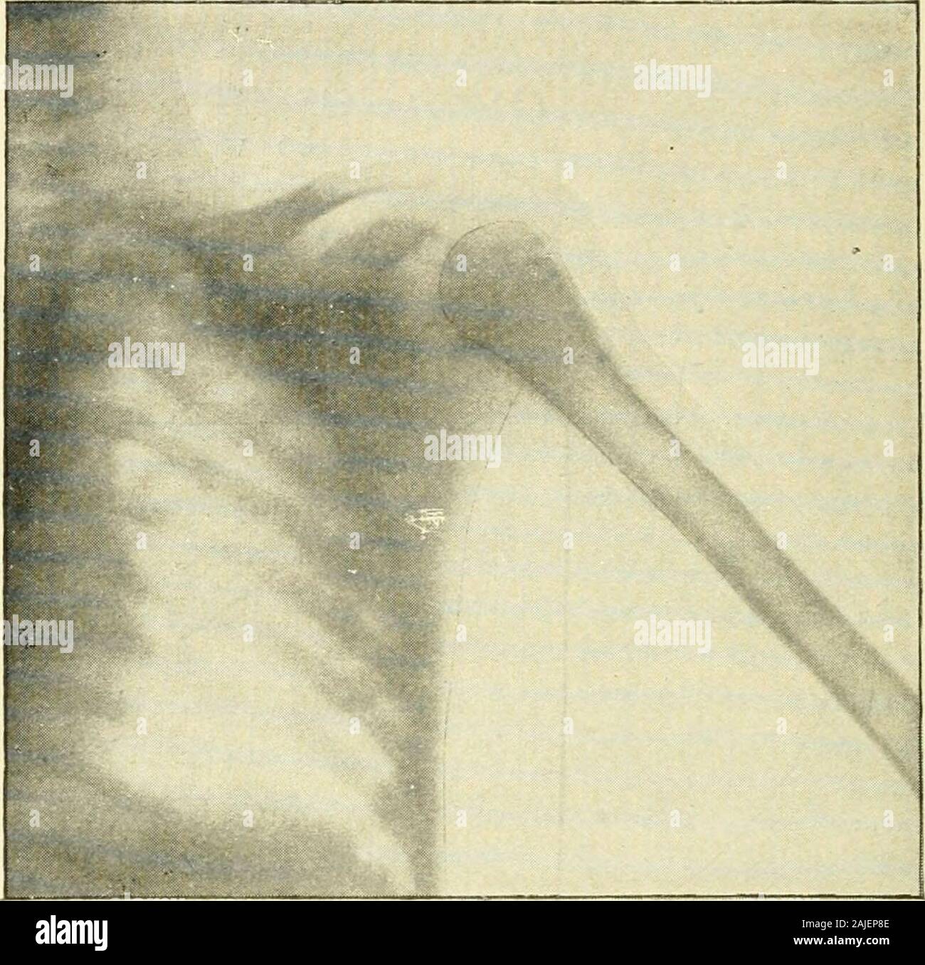 The treatment of fractures . s areespecially common in children. Intra ...