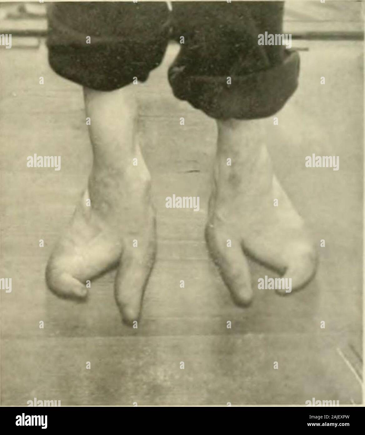 Treasury of human inheritance . f. Fi. 2. Photograpli of feet of R.E.G ...