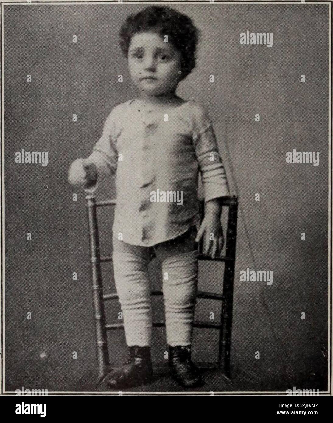 Rickets legs hi-res stock photography and images - Alamy