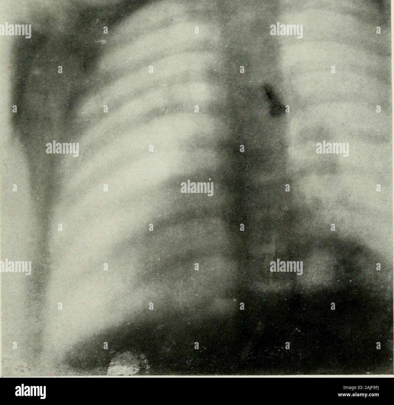 Foreign bodies x ray hi-res stock photography and images - Alamy