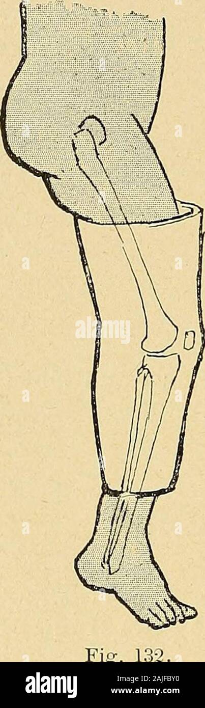 Plâtre orthopédique hi-res stock photography and images - Alamy