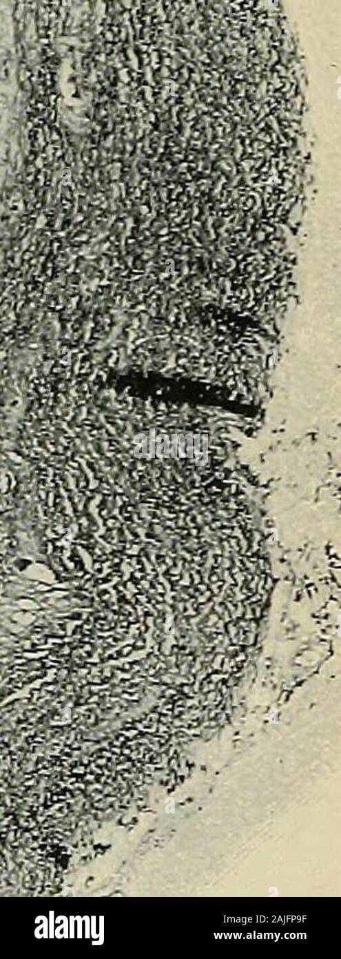 Organizing blood clot hi-res stock photography and images - Alamy