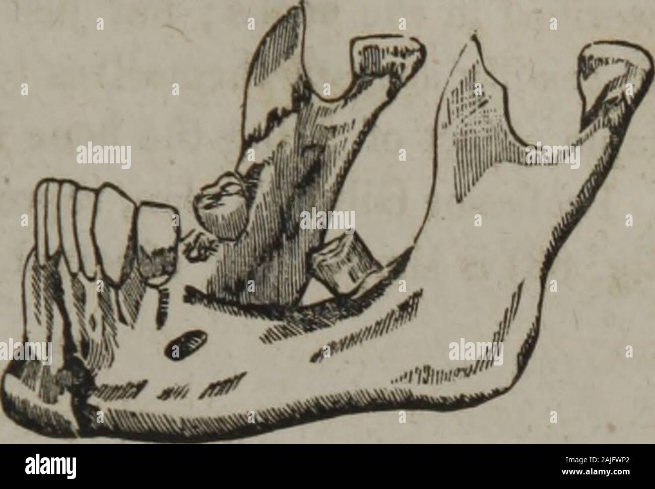 Nasal bone fracture surgery hi-res stock photography and images - Alamy