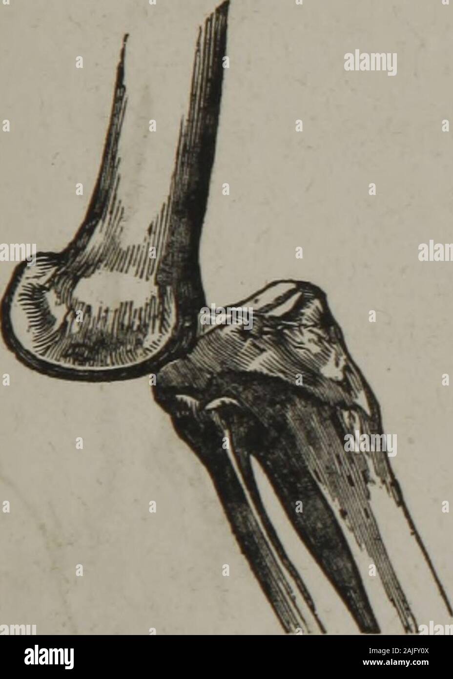 Anterior dislocation of the knee hi-res stock photography and images ...