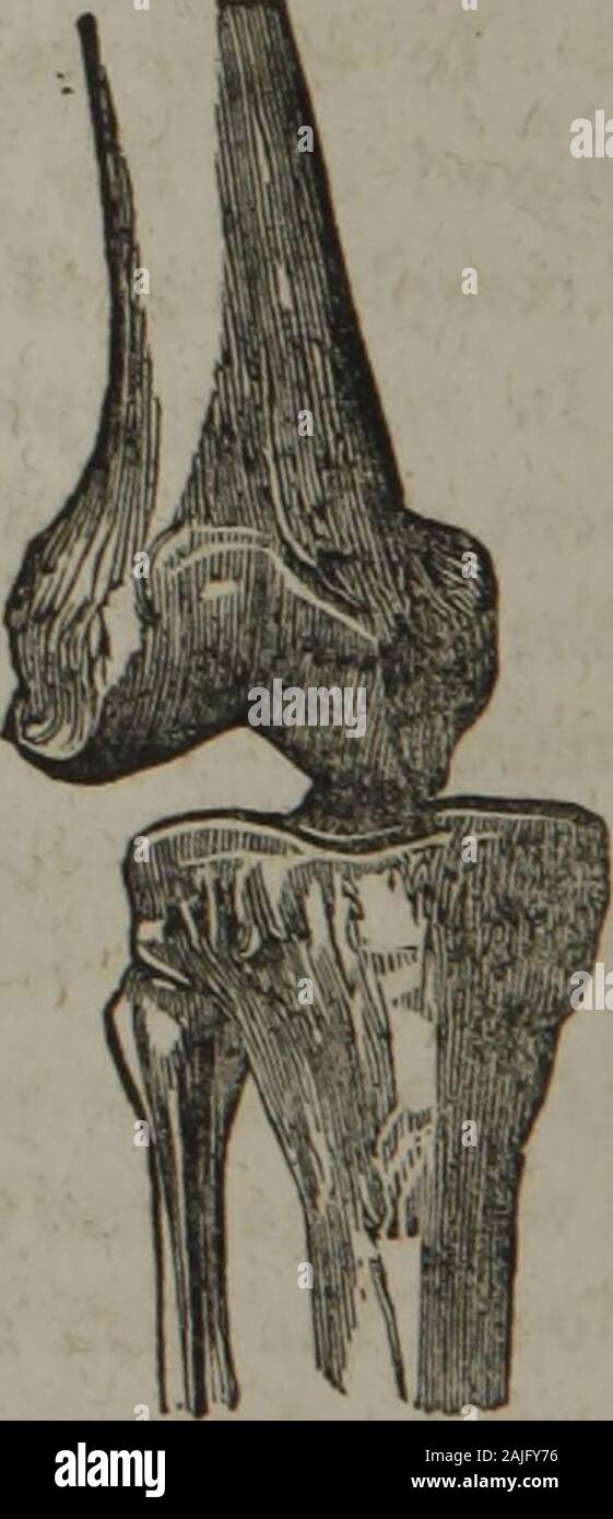 Anterior dislocation of the knee hi-res stock photography and images ...