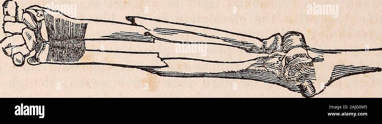 Fracture olecranon process of ulna hi-res stock photography and images ...