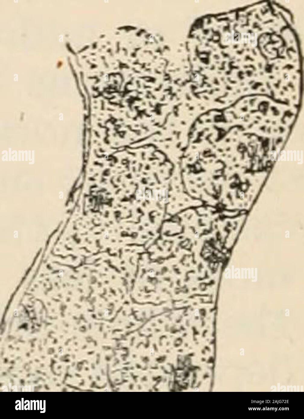 Acute nephritis hi-res stock photography and images - Alamy