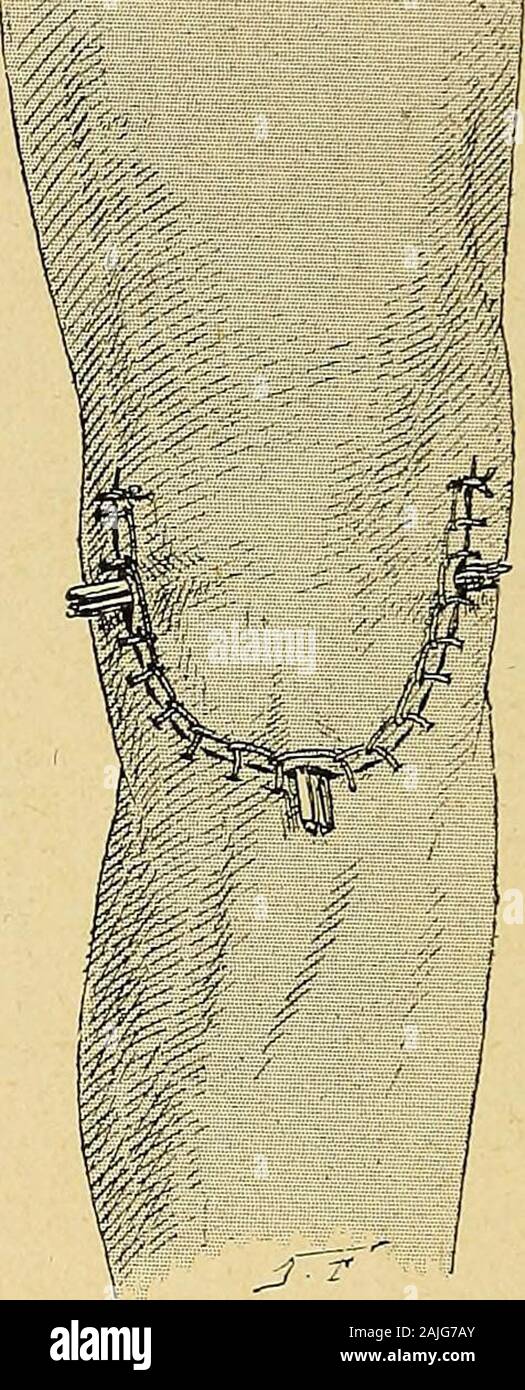 Points de suture résorbables hi-res stock photography and images - Alamy