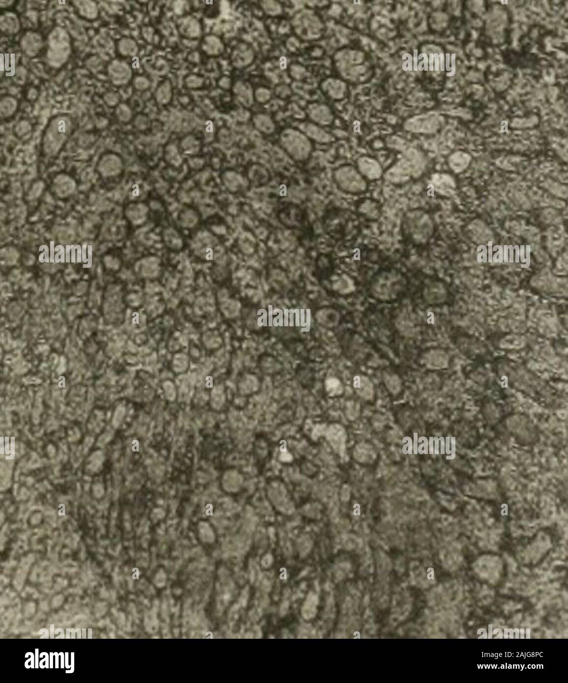 Transactions . .?^ ?«^*-.,-,. PLATE 3, POLYPOID ANGIOMA OF THE EAR ...