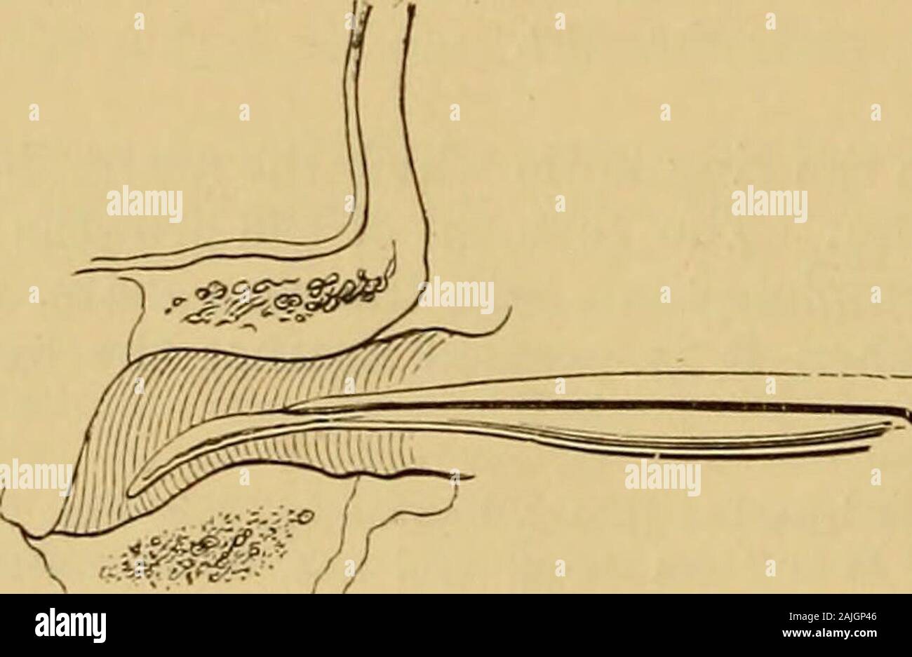 Granulation tissue hi-res stock photography and images - Alamy