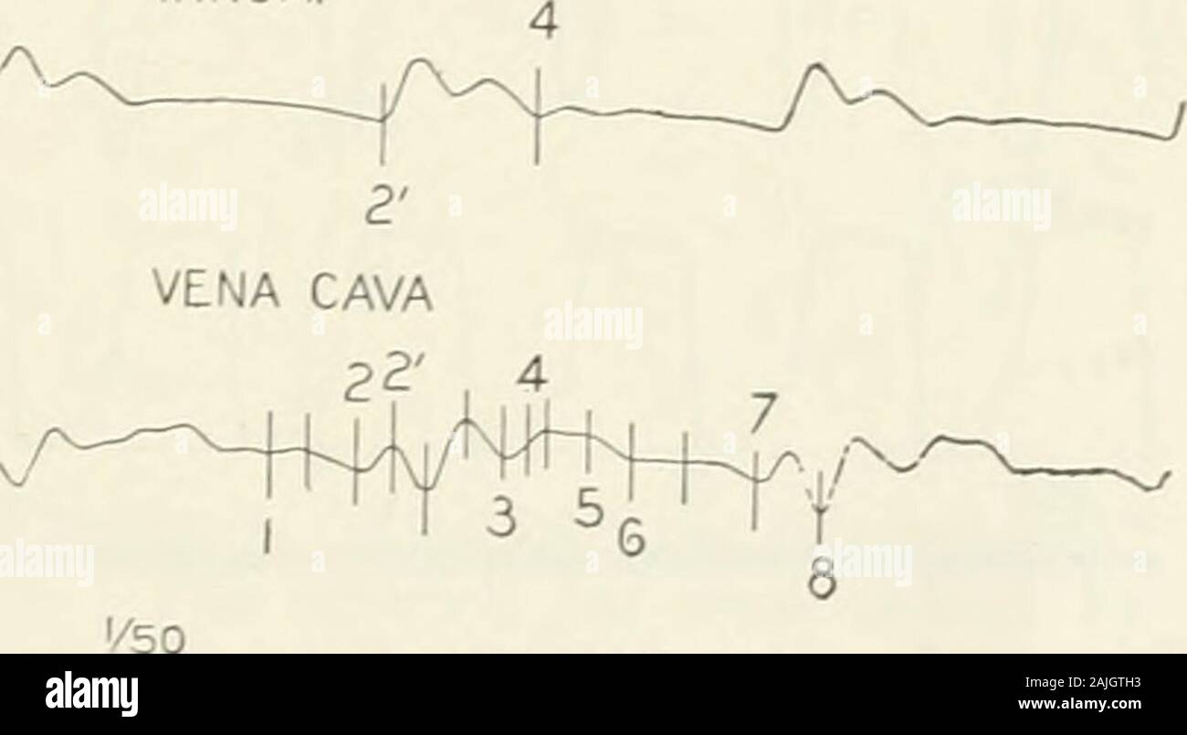 Myogram hi-res stock photography and images - Alamy