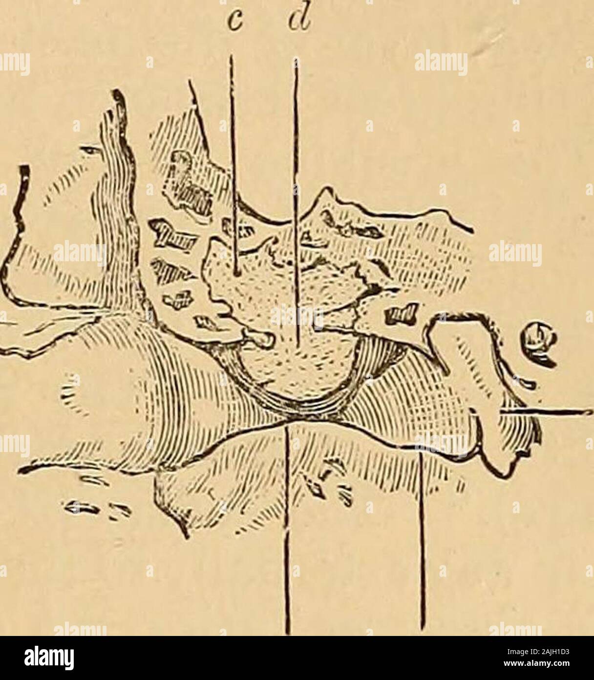 Mastoid cases hi-res stock photography and images - Alamy