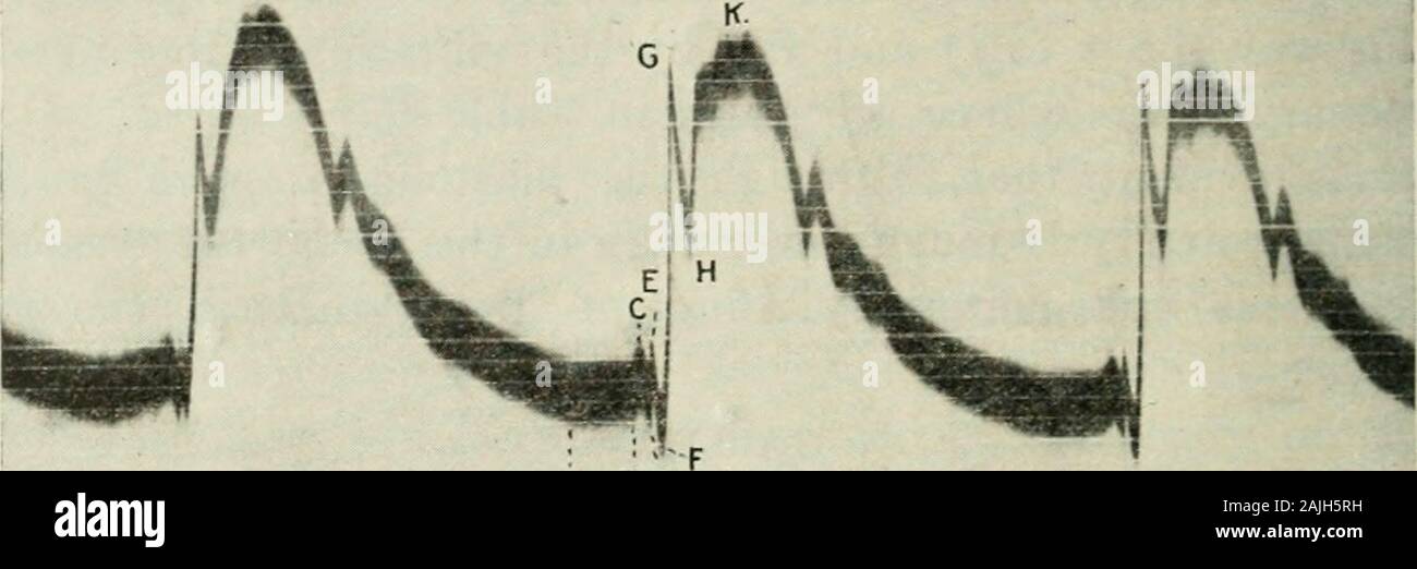 Pulmonary waves hi-res stock photography and images - Alamy