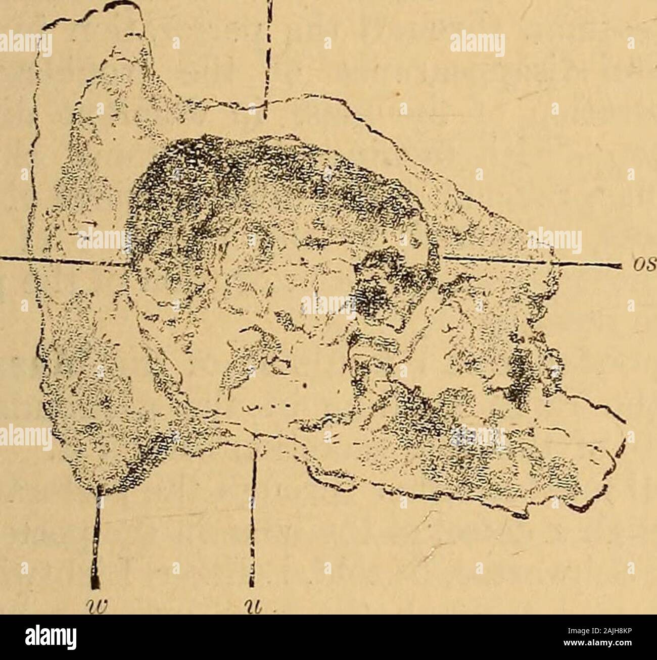 Cholesteatoma hi-res stock photography and images - Alamy