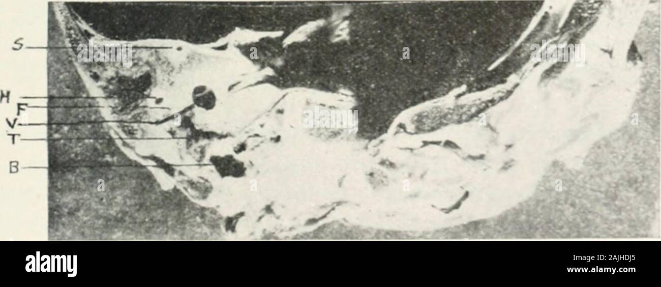 Right transverse sinus hi-res stock photography and images - Alamy