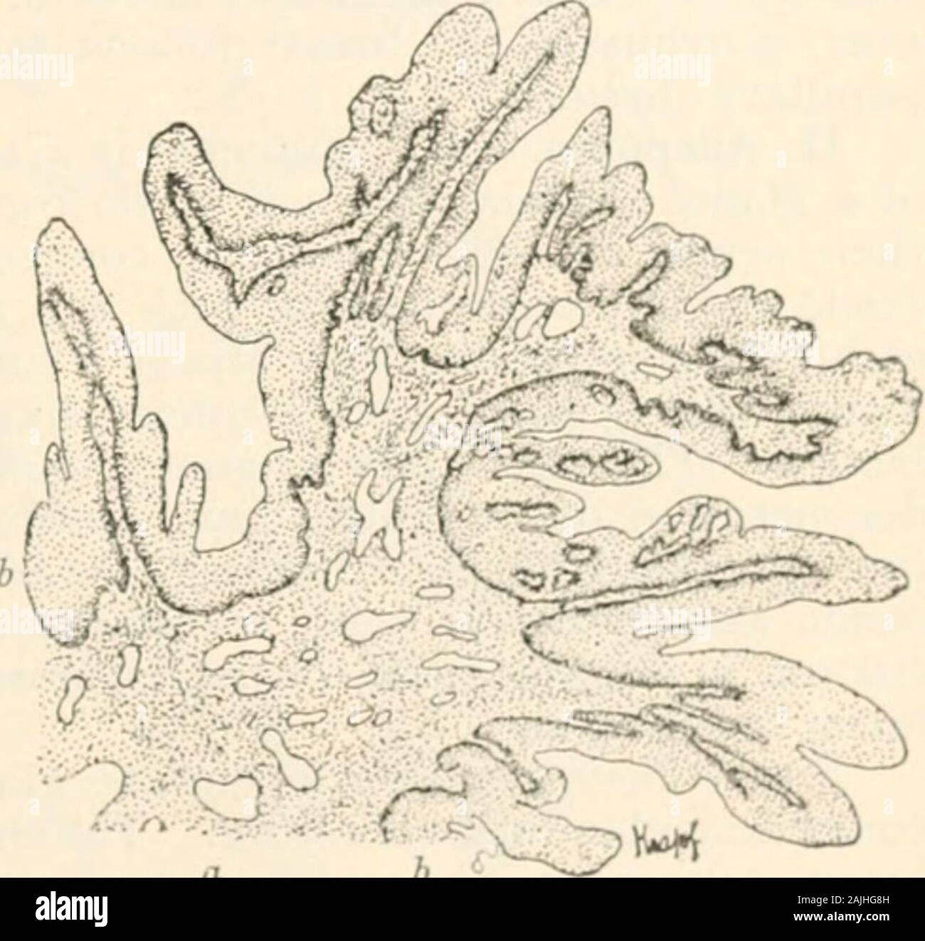 Hemor hi-res stock photography and images - Alamy