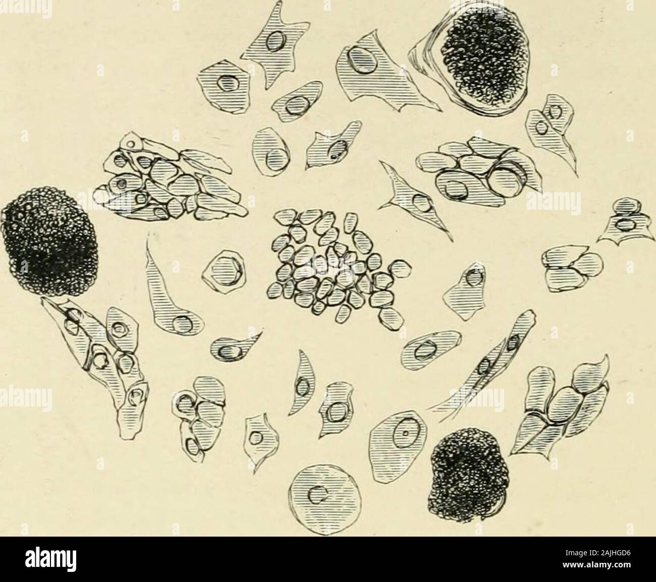Irish journal of medical science . Fig. 14.—The cancer cells from E. M ...