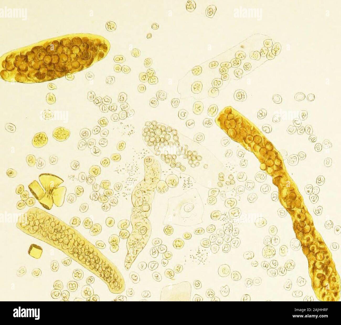 Bilirubin Crystals In Bile