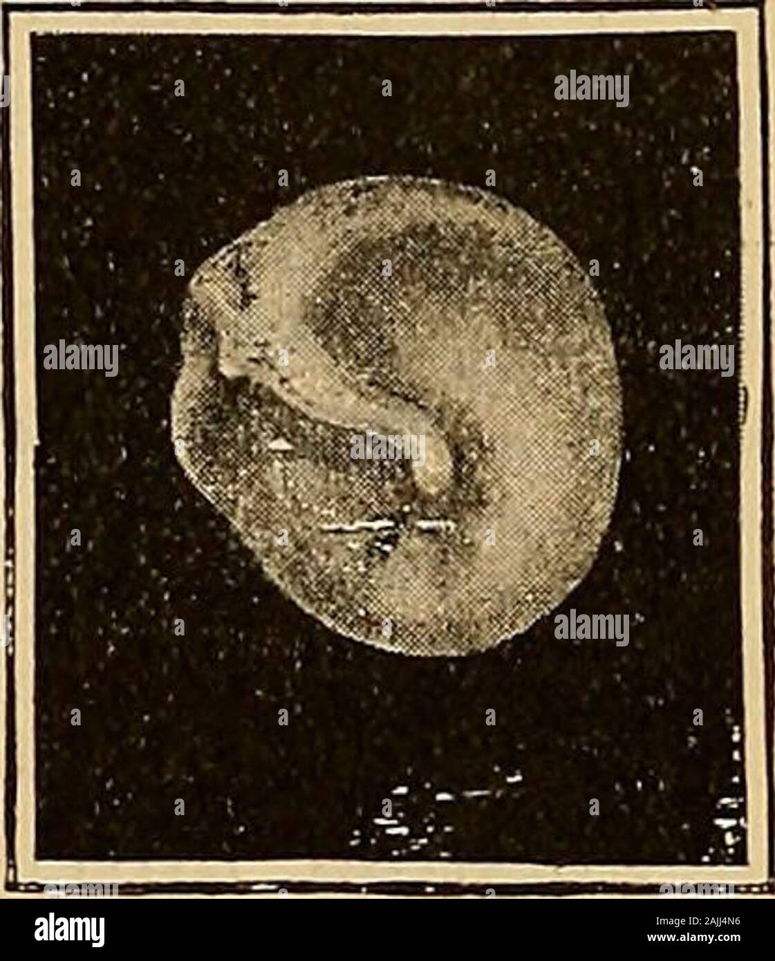 Tympanic membrane perforation hi-res stock photography and images - Alamy