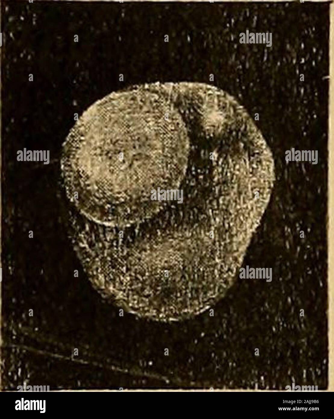 Myringitis hi-res stock photography and images - Alamy