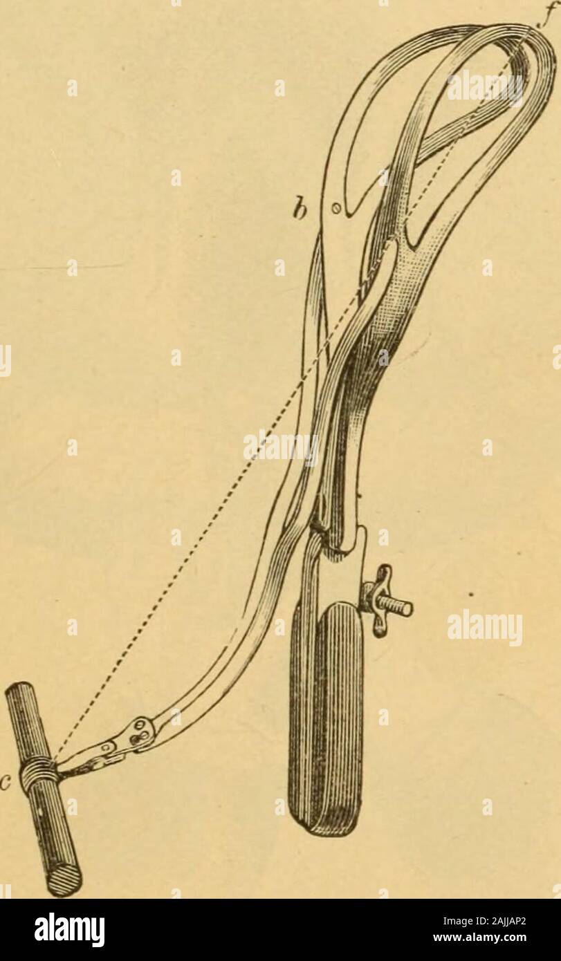 Perforated uterus hi-res stock photography and images - Alamy