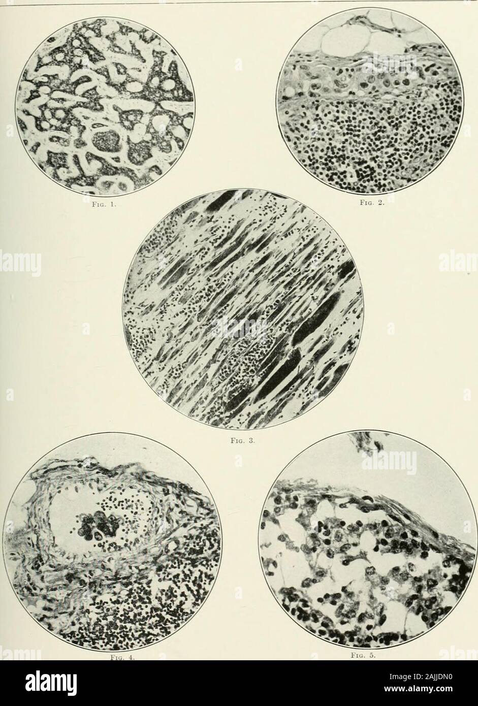 Cylindroma hi-res stock photography and images - Alamy