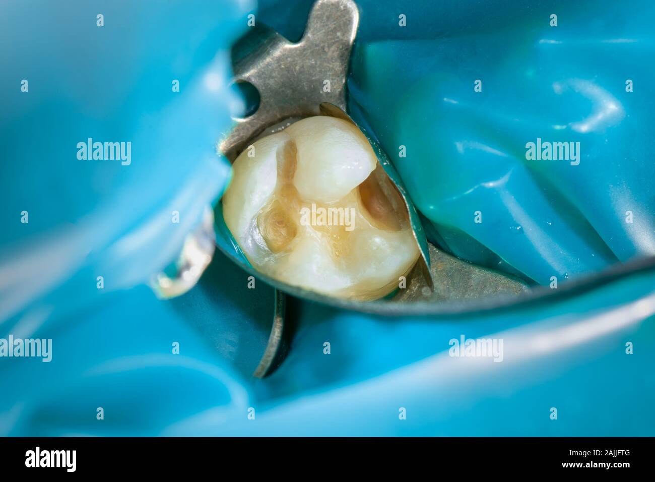 two chewing side teeth of the upper jaw after treatment of caries ...