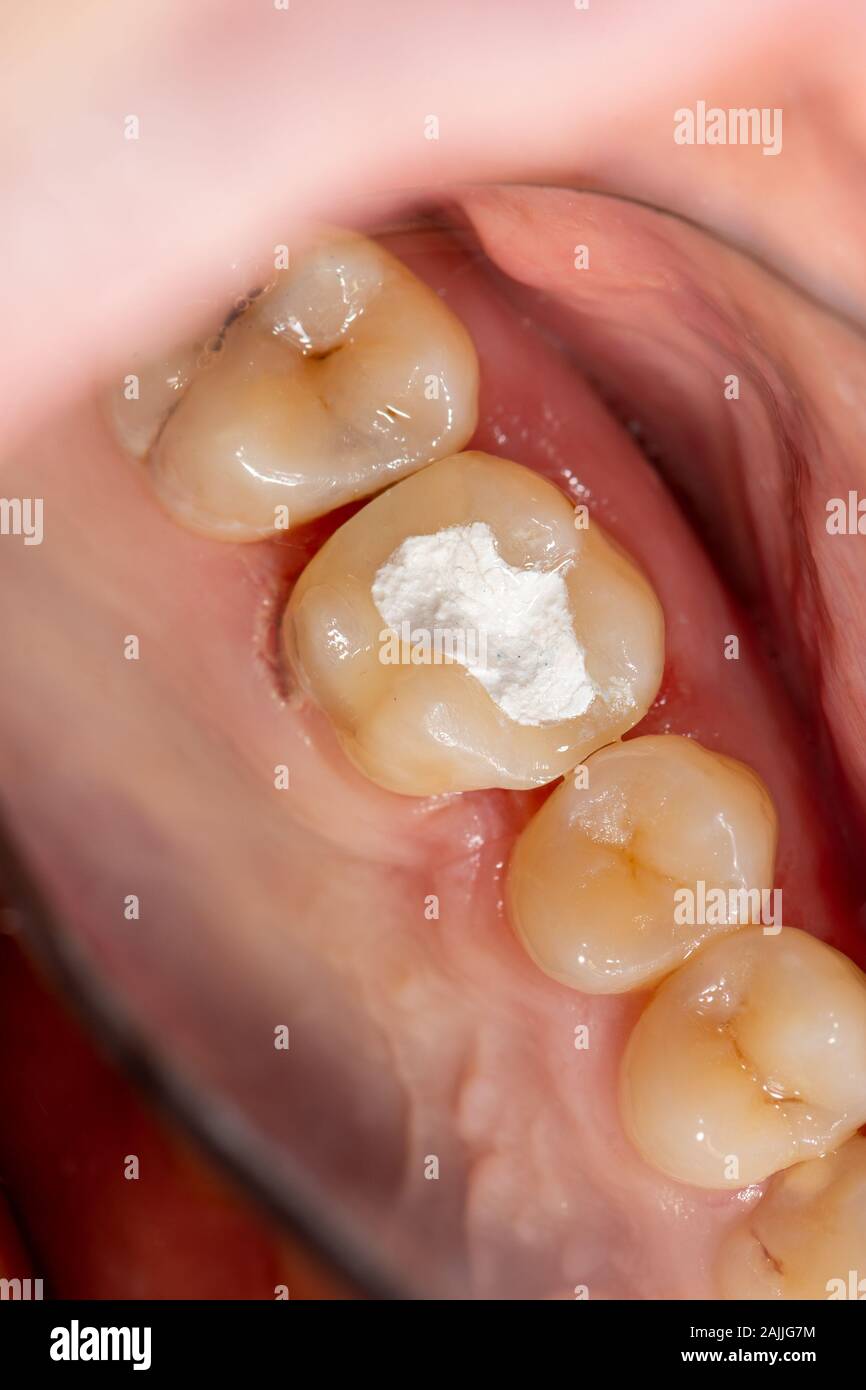 Sealing tooth hi-res stock photography and images - Alamy