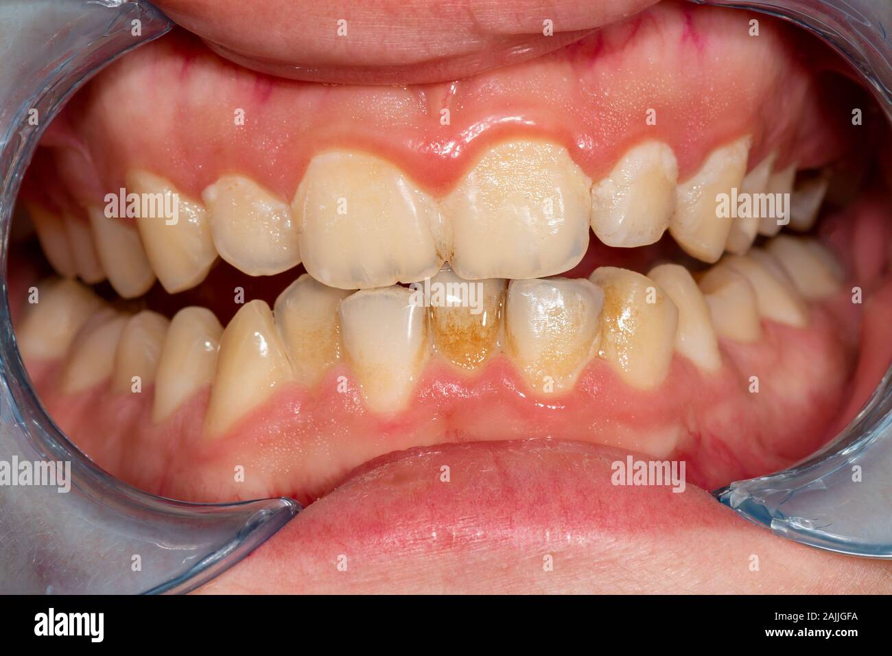 Plaque of the patient, stone. Dentistry treatment dental plaque ...