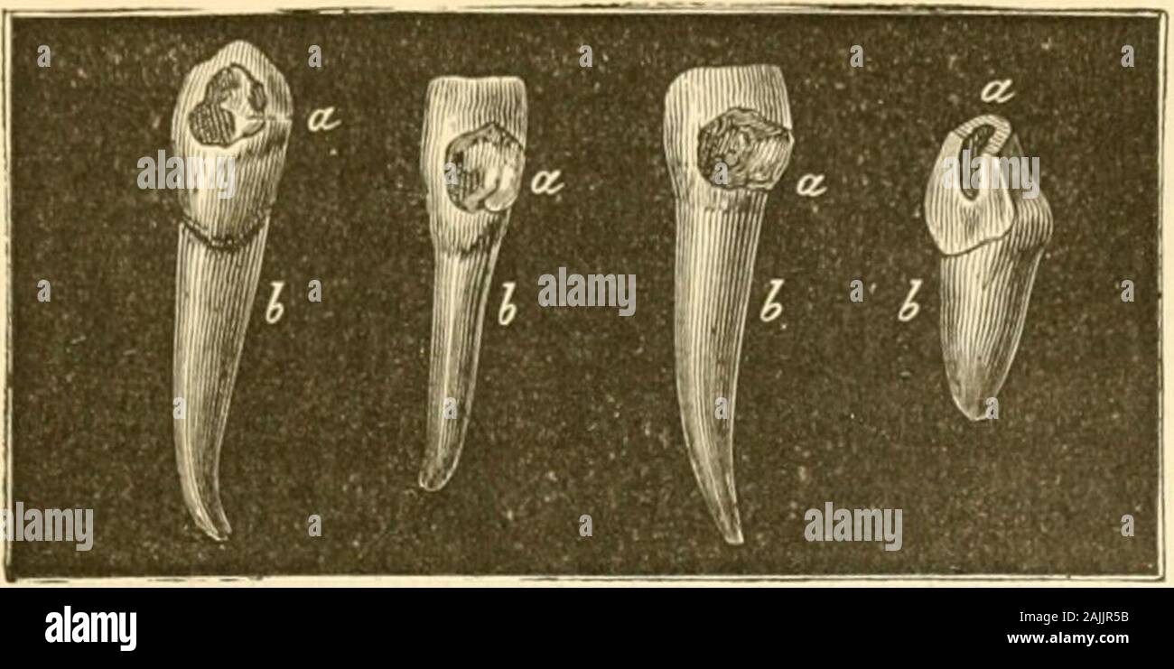 Treatise on dental caries : experimental and therapeutic investigations ...