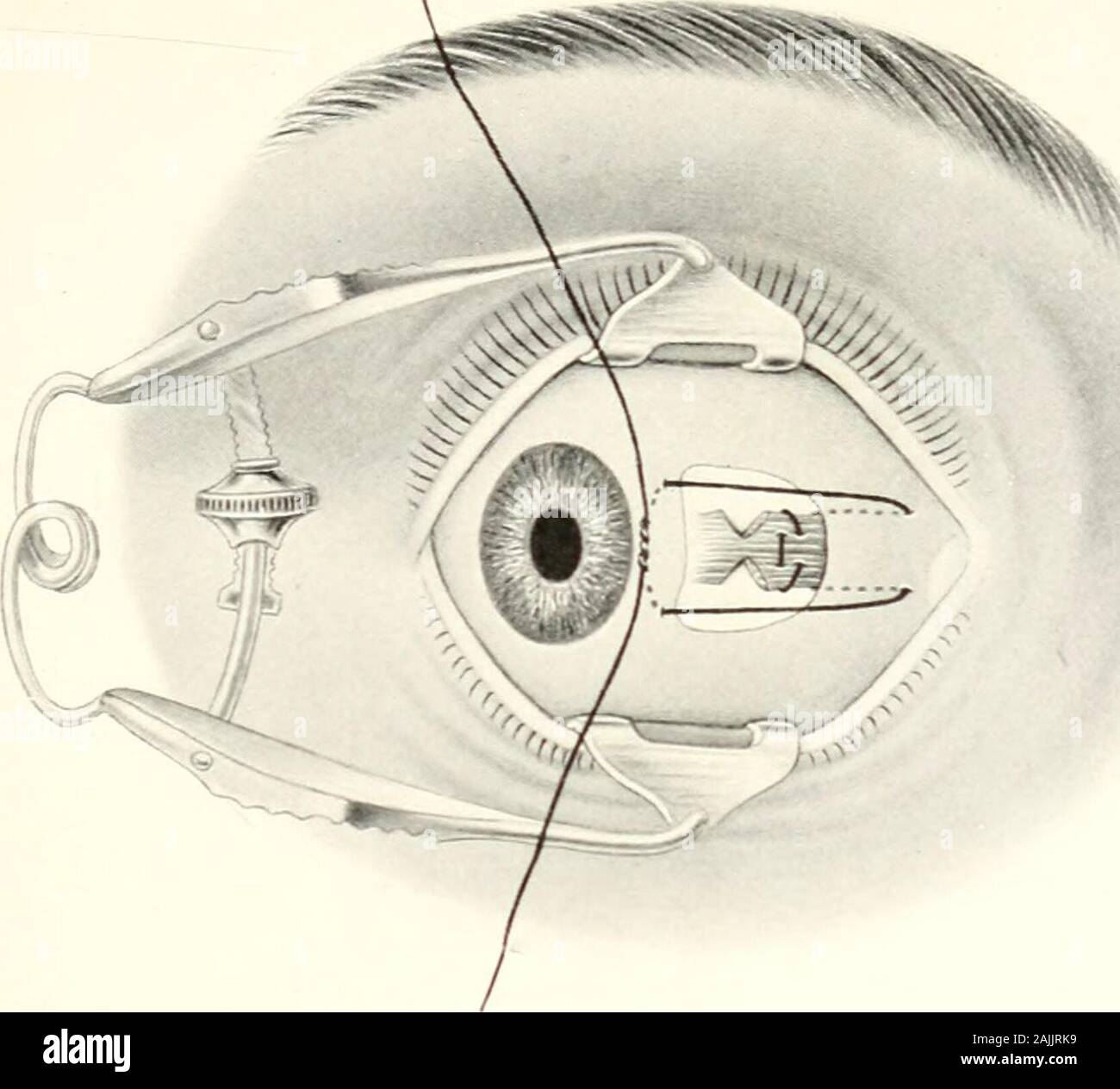 Transactions . ues per-fectly flat against the sclera and will ...