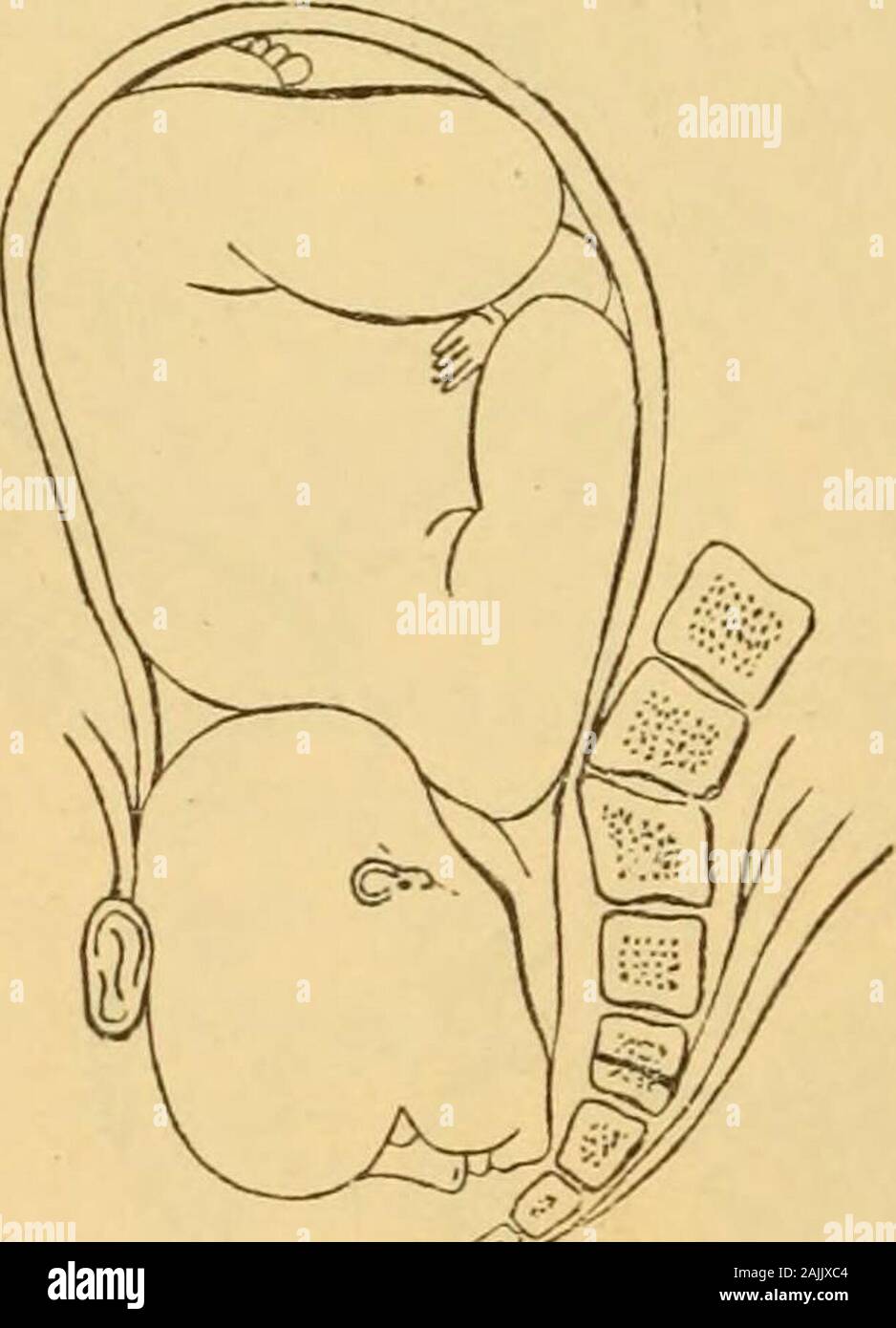 A manual of practical obstetrics . ace presentation. Mechanism in Right ...
