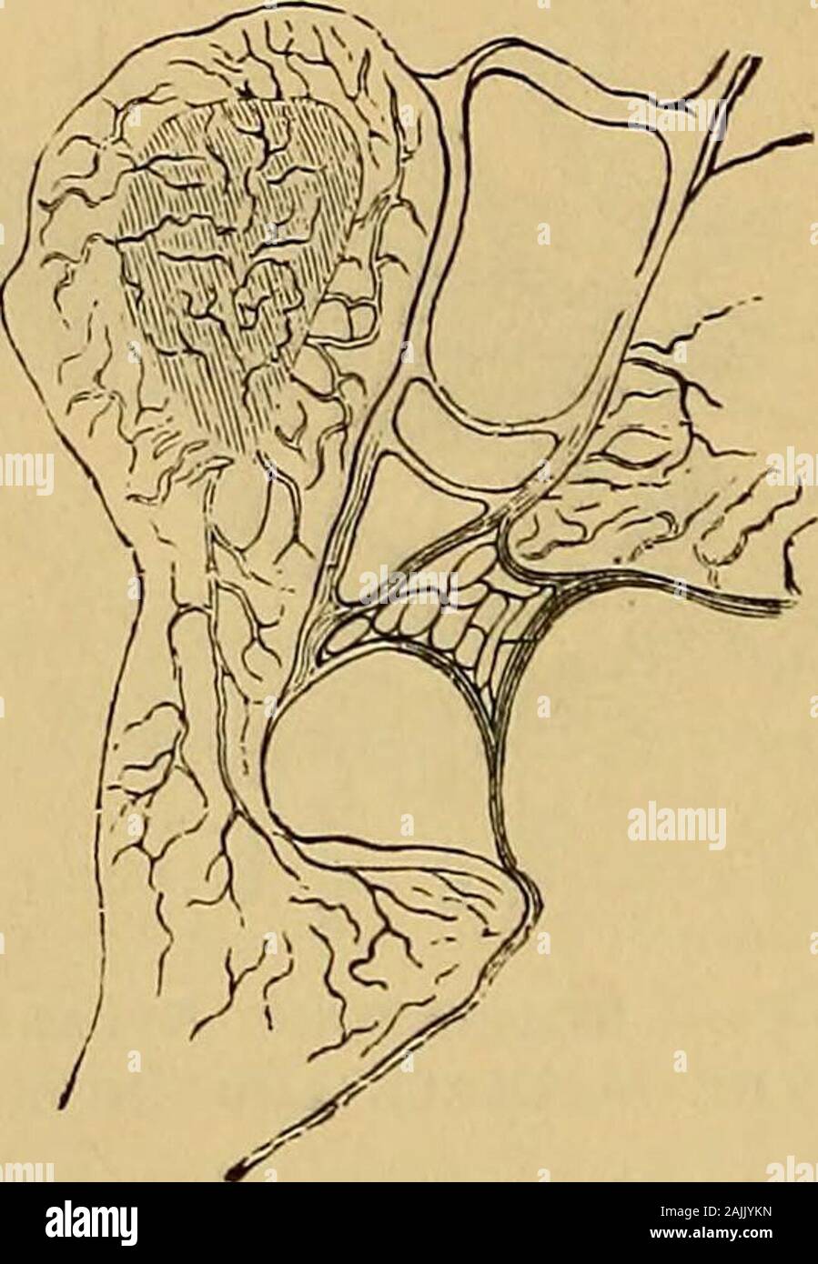 Aditus Ad Antrum Otitis Media | Radiology Case | Radiopaedia.org