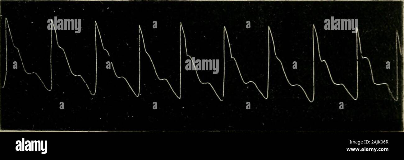 The physical signs of cardiac disease, for the use of clinical students ...