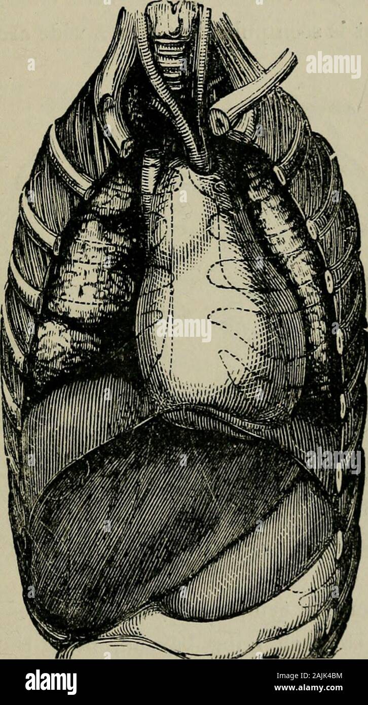 Enlarged heart ventricle hi-res stock photography and images - Alamy