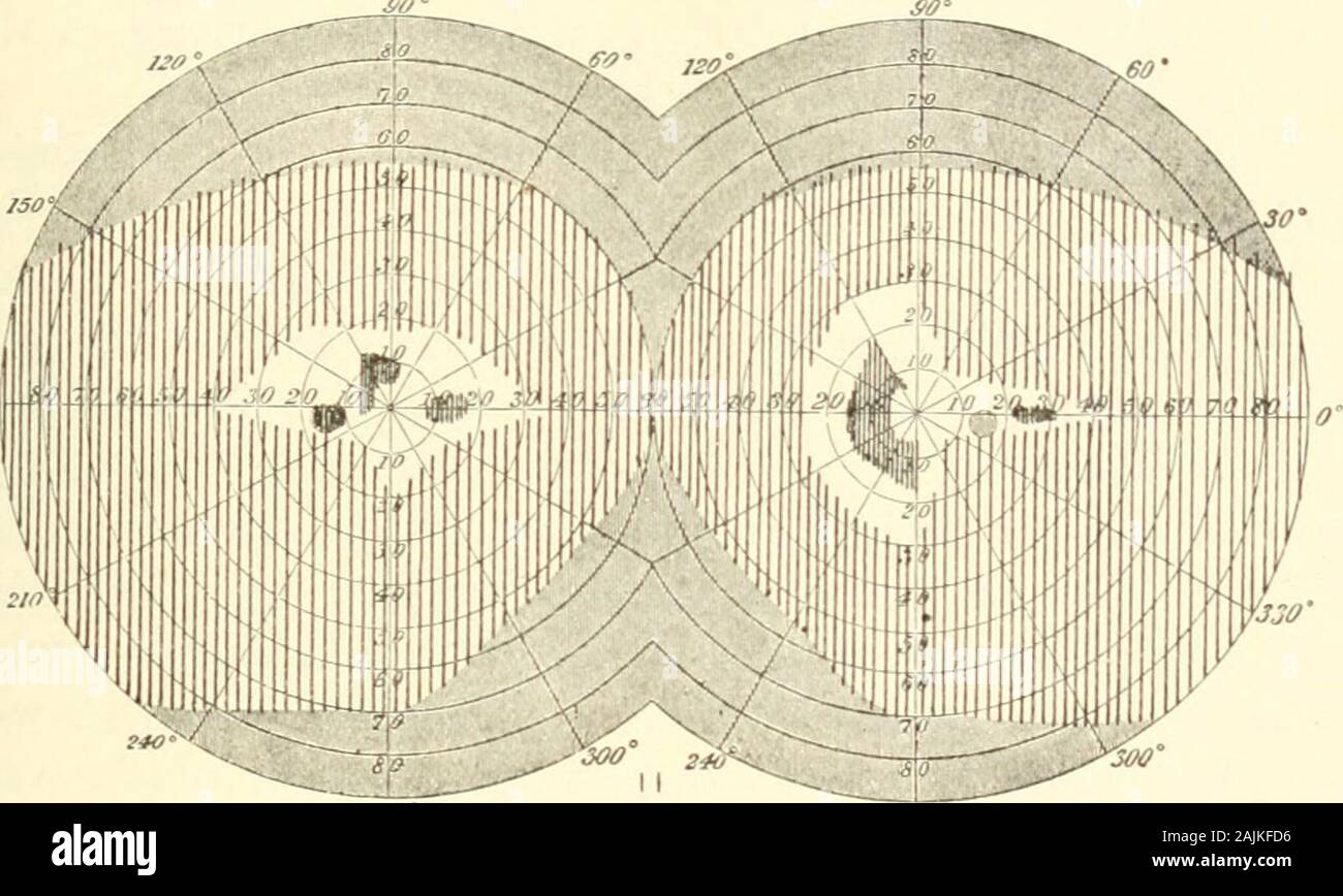 Visual field defect hi-res stock photography and images - Alamy