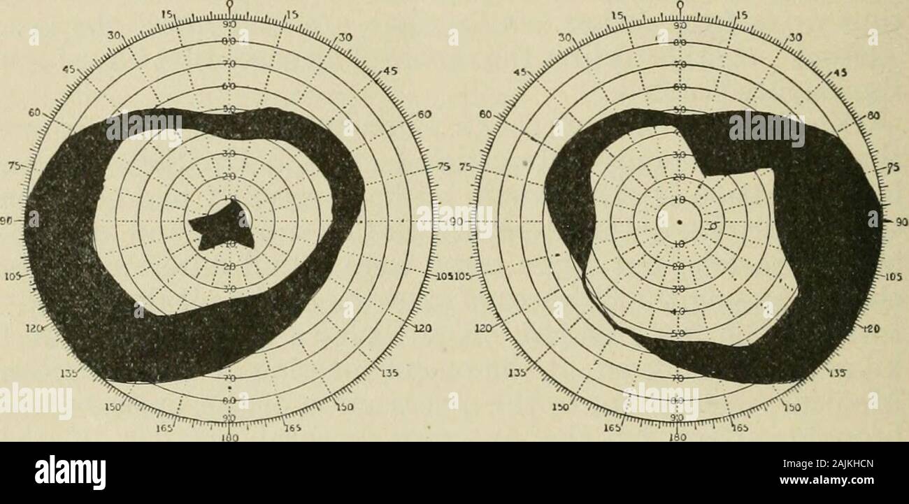 Bitemporal hemianopsia hi-res stock photography and images - Alamy