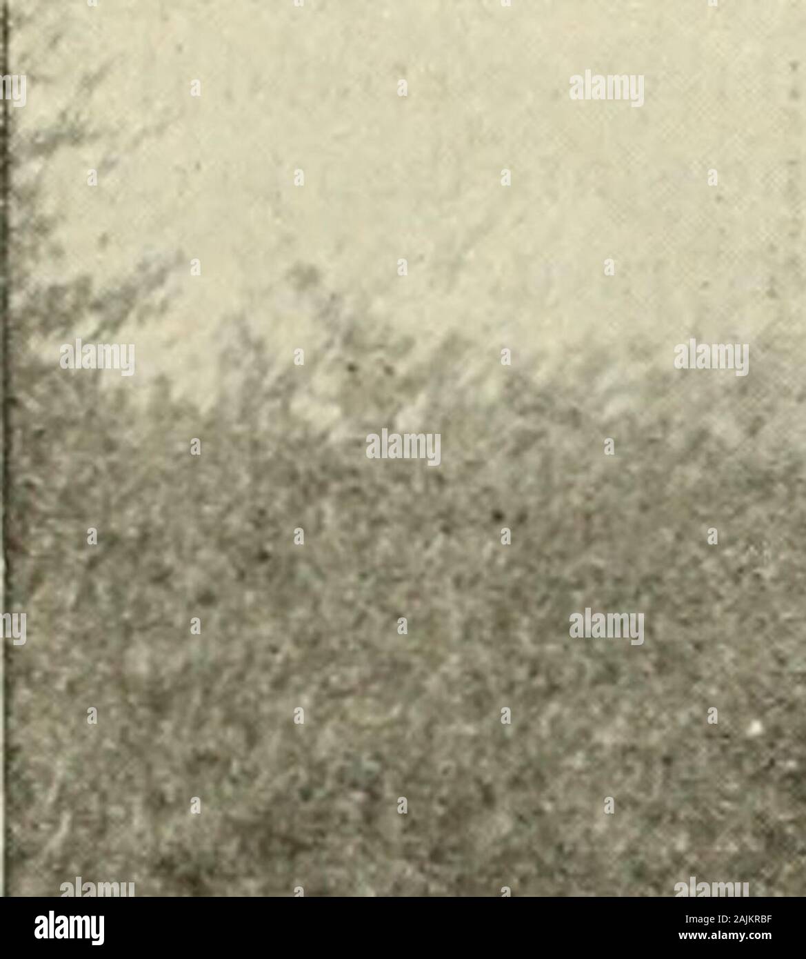 Inflamed intestines hi-res stock photography and images - Alamy