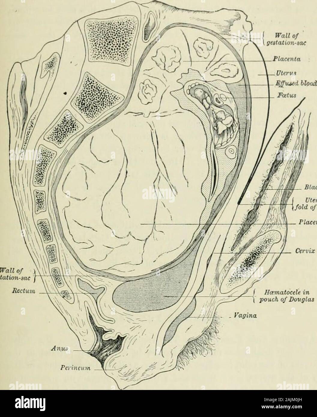 Gynecological diagnosis and pathology . lied to haemorrhage into the ...