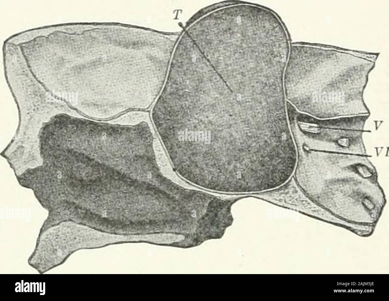 Bleeding from the tumor hi-res stock photography and images - Alamy